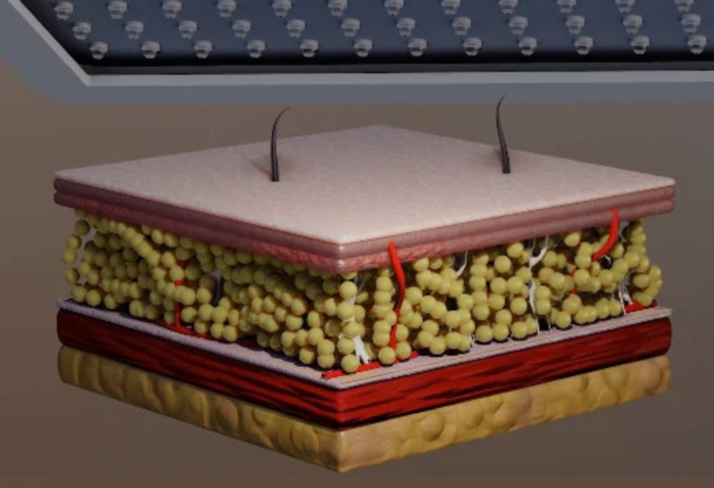 How does it work? – UltraSlim® North Georgia